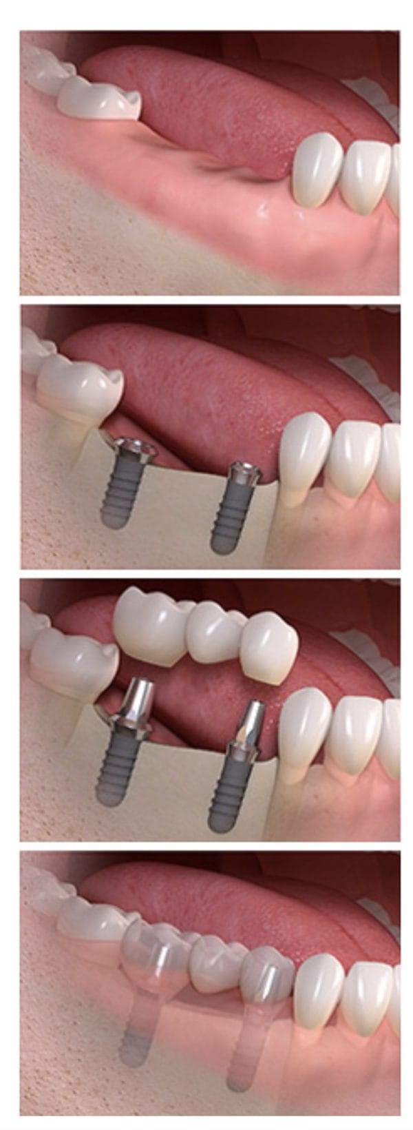 Implant-Supported Bridges North Hollywood, CA - Nuevo Dental